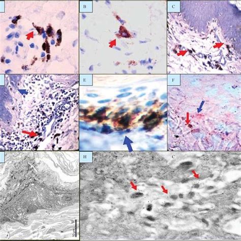 A A Dermal Antigen Presenting Cell Brown Staining Blue Arrow In