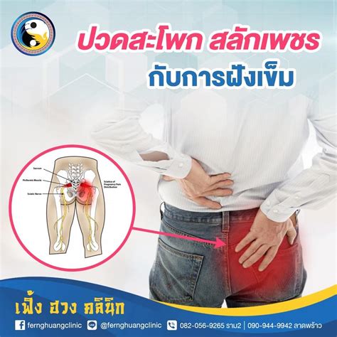 😖 กล้ามเนื้อสะโพกหนีบเส้นประสาท Piriformis Syndrome เกิดจากกล้ามเนื้อ Piriformis ซึ่งเป็น