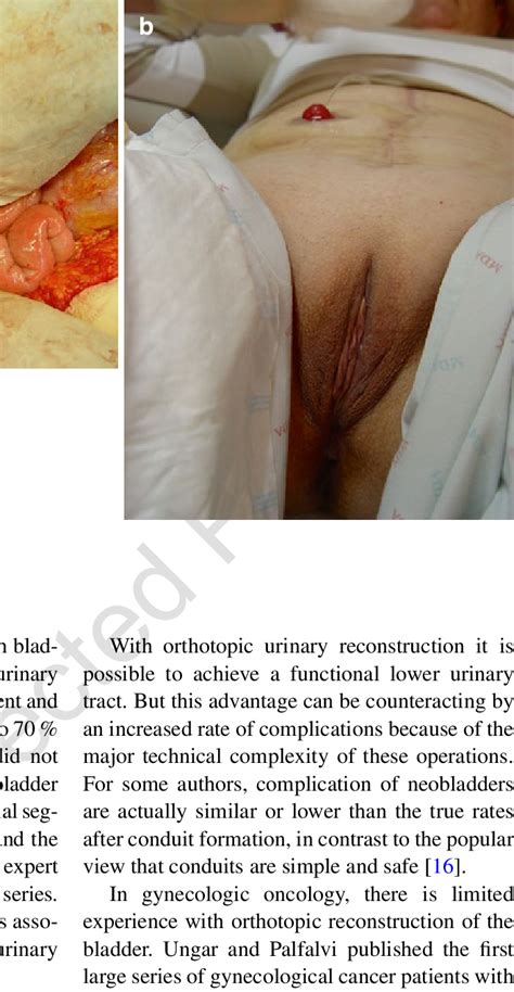 2 A B Ileal Conduit And Urinary Stoma Download Scientific Diagram