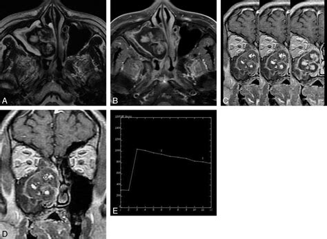 Case 16 Sinonasal Angiomatous Polyp In An 80 Year Old Man A Axial Download Scientific