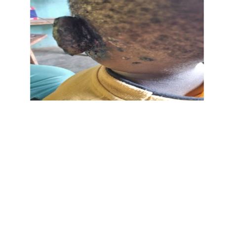 Year Old Man With Pyoderma Gangrenosum Of Nghtlateral Chest A Download Scientific Diagram