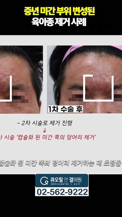 중년 미간부위 변성된 육아종 제거 사례 Youtube