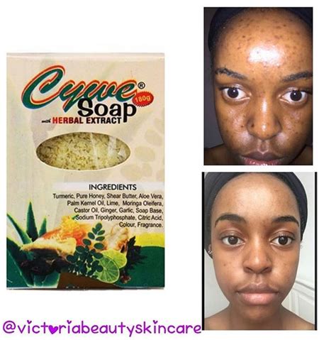 Please What Can I Use To Cure The Pimples On My Face Romance 2 Nigeria