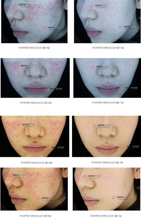 홍조치료의 중심 리미지한의원 30세 여자 이님 주사피부염 치료사례