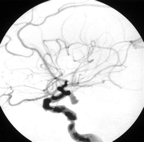 Surgical Treatment Of 127 Anterior Choroidal Artery Aneurysms