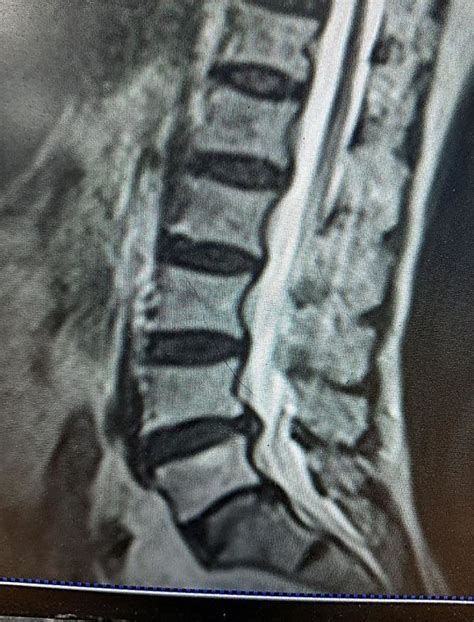 sagittal view mri t2 weighted image loss of normal signal intensity of