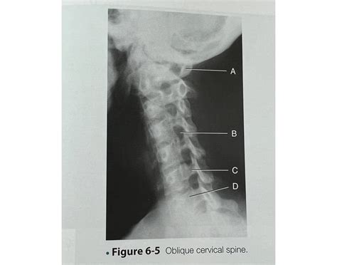 Obl C Spine Quiz