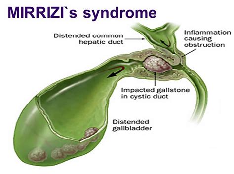 Mirizzi Syndrome Causes Types Symptoms Diagnosis Treatment And Prognosis