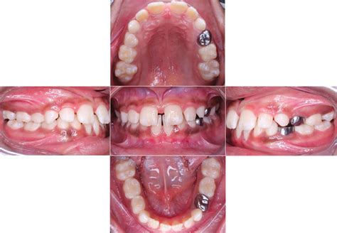Behavioral And Dental Management Of A Pediatric Patient Diagnosed With Autoimmune Encephalitis