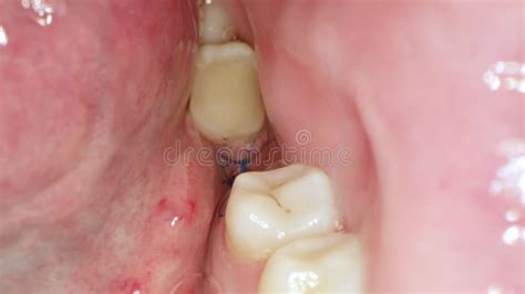 Close Up Oral Cavity Of A Patient Who Has Just Had A Gum Augmentation