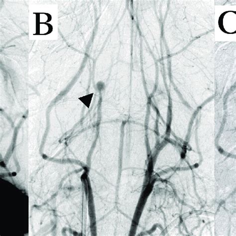 In Vivo Dsa Showed Intracranial Pseudoaneurysms In Three C57bl6j Mice