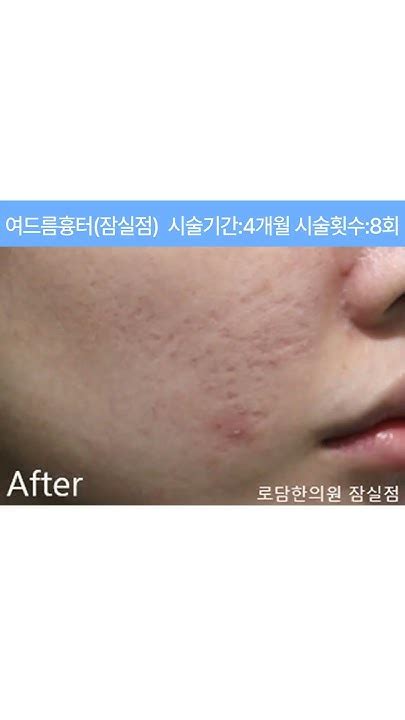 Shorts 얼굴패인흉터 새살침 코라테라피여드름흉터 치료결과는 Youtube
