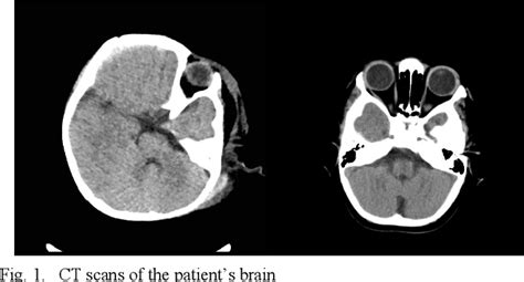 Figure 1 From Automated Intracranial Hemorrhage Detection Using Deep Learning In Medical Image