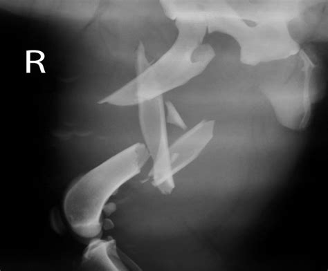 Artrovet Fractura Conminuta De Fémur 1ª Parte