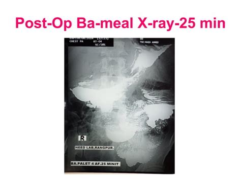 Post Operative Gastro Jejunostomy Efferent Loop Obstruction Due To Recurrent Ulcer With