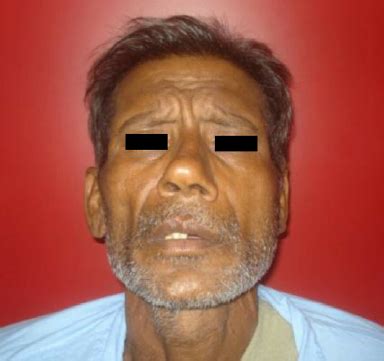 Diffuse Swelling Lt Side Of Face Download Scientific Diagram