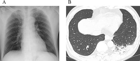 Three Cases Of Hospitalized Legionella Pneumonia Patients Successfully