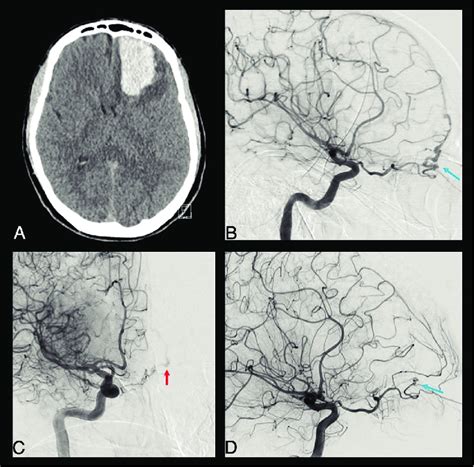 Clinical Case Of A Ruptured Cribriform Plate Davf A 49 Year Old Man