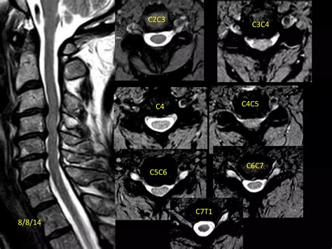 Pseudarthrosis Cervical Spine Ppt