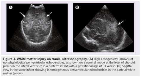 Radiological Assessment Of White Matter Injury In Very Preterm In