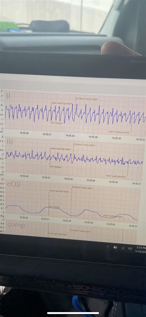 Vtach Or Aberrancy Rekgs