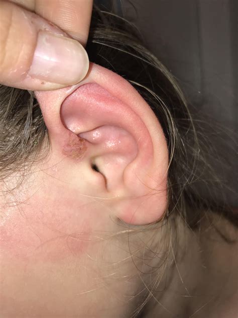 Healing Progression Of Ear Cellulitis Cartilaginous Infection In A 6yof Pt Has Made Full