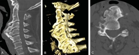 Case One Sagittal A And Three Dimensional Sagittal Reconstruction