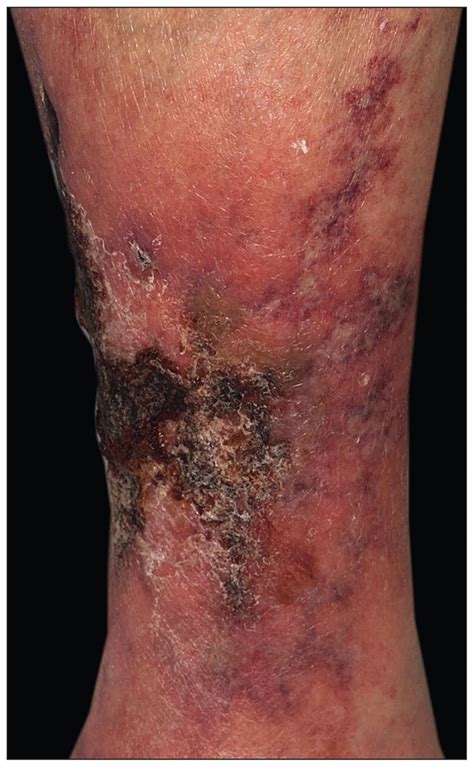 Calciphylaxis A Severe Complication Of Renal Disease Cmaj