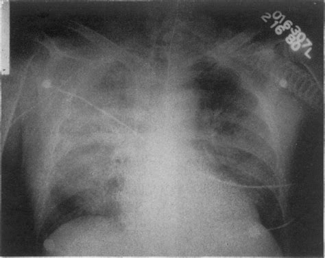 Anterioposterior Chest Radiograph Showing Bilateral Diffuse Homogeneous Download Scientific