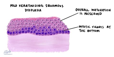 Your Pathology Report For Keratinizing Squamous Dysplasia Of The Oral Cavity Mypathologyreport