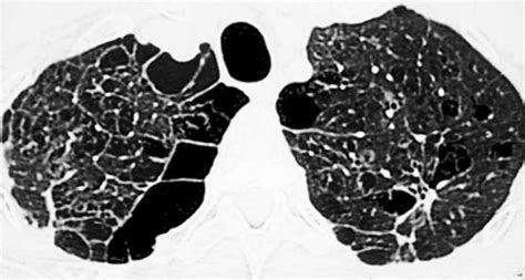 Casos Clínicos Doenças Pulmonares Sanarmed