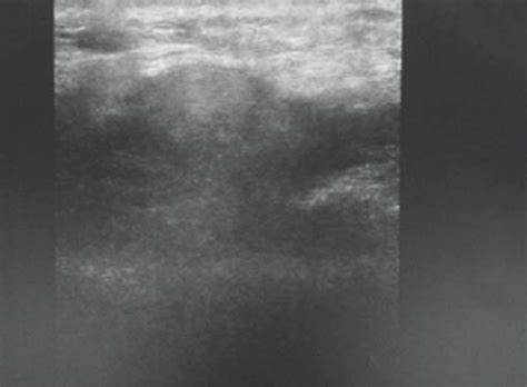 USG Pattern Hyperechoic Pattern USG Diagnosis Cellulitis Download Scientific Diagram