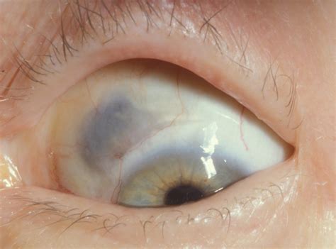 Moran CORE Scleritis