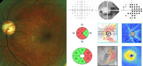 Utilizing Oct For Glaucoma Diagnosis And Management