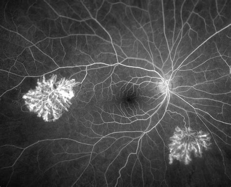 Multiple Sclerosis Vasculitis And Neovascularization Credit Austin Retina Photograpgy Rao