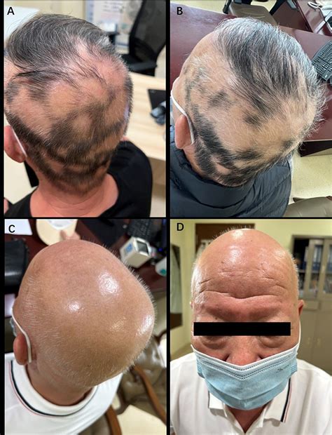 Alopecia Universalis In An Elderly Chinese Man Jir