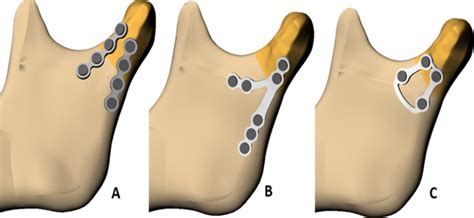 Clinical Characteristics And Treatment Of Superolateral Dislocation Of The Mandibular Condyle
