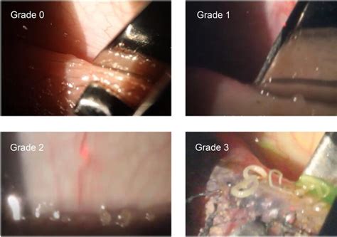 The Mgd Subjective Grading Scale Notes Grade 0 Is Normal Meibum