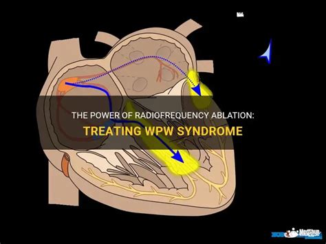 The Power Of Radiofrequency Ablation Treating Wpw Syndrome Medshun