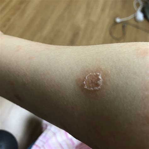 장미색비강진 투병일기 네이버 블로그