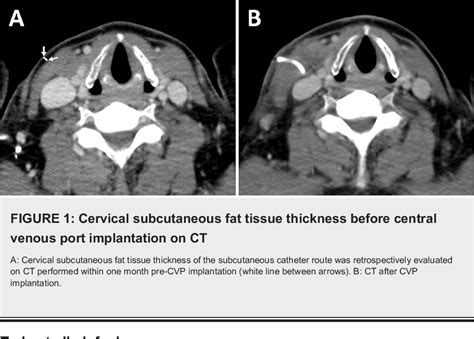 Figure From Differences In The Incidence Of Sterile Inflammation After Trabectedin Infusion