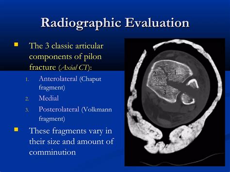 39 Tibial Plafond Pilon Fractures Ppt