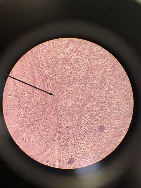 What Is Fibrocartilage