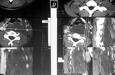 Ent Retropharyngeal Abscess Radioogle