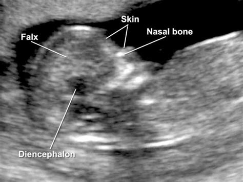 Should The Frontal Bone Be Visualized In Midline Sagittal Views Of The
