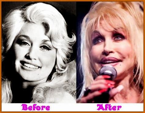 Best Images About Before And After Plastic Surgery On Pinterest Plastic Surgery Heidi
