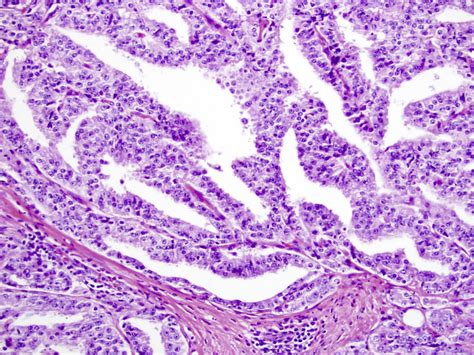Pathology Outlines Gleason Grading