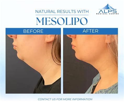 Mesolipo Alps Medical Centre