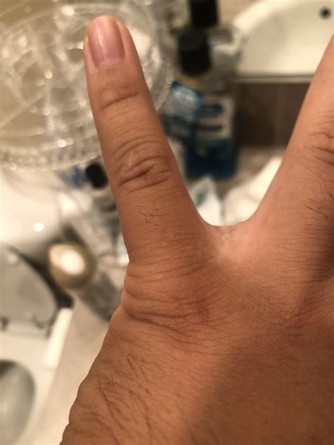 Does This Look Like Scabies Please Help More Information In The Comments Scabies