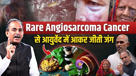 Angiosarcoma 4 Stage Cancer Treatment Aggressive Rare Cancer